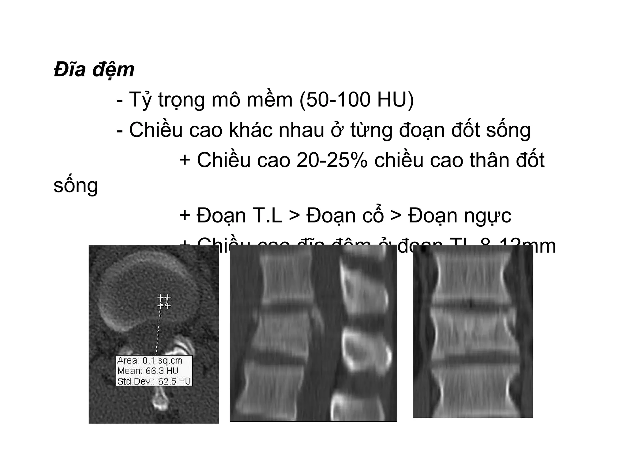 Giải phẫu cột sống và hình ảnh chấn thương cột sống trên clvt | PPT