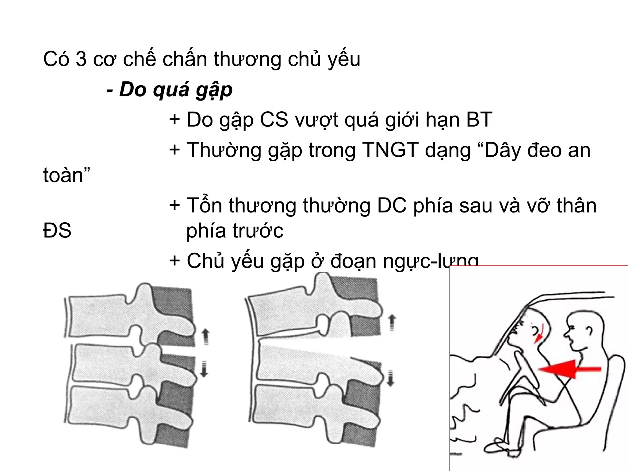Giải phẫu cột sống và hình ảnh chấn thương cột sống trên clvt | PPT