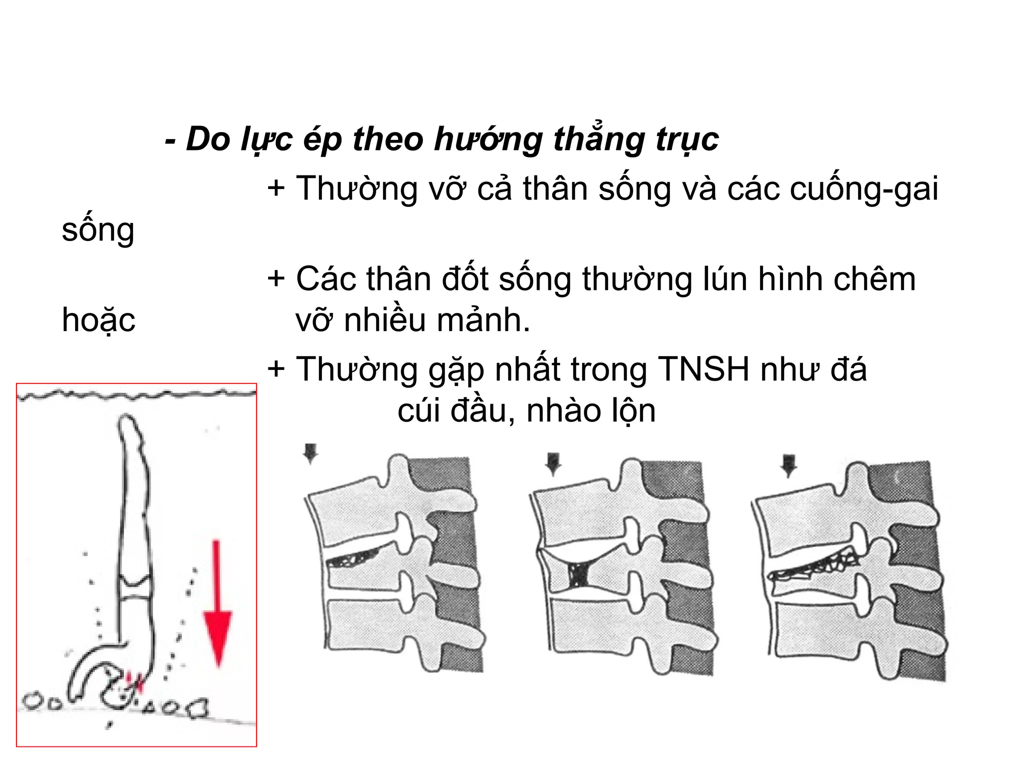 Giải phẫu cột sống và hình ảnh chấn thương cột sống trên clvt | PPT