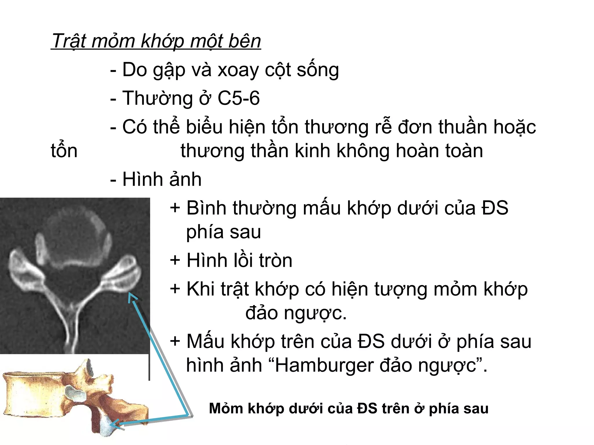 Giải phẫu cột sống và hình ảnh chấn thương cột sống trên clvt | PPT