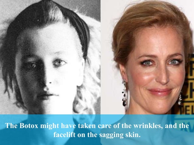 Gillian anderson plastic surgery | PPTX