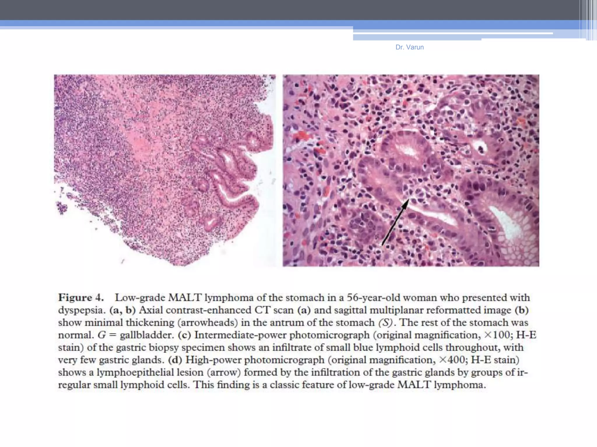 Gastrointestinal lymphoma | PPTX