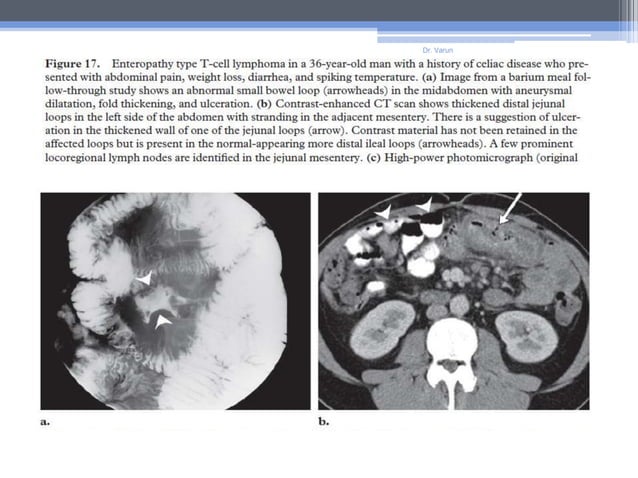 Gastrointestinal lymphoma | PPTX | Digestive Disorders | Diseases and ...