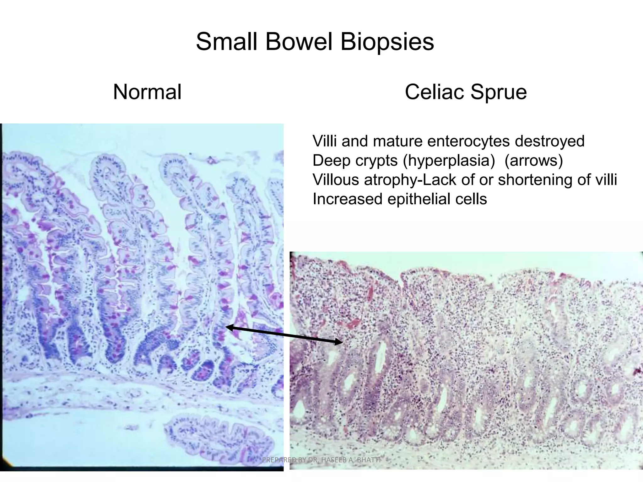 Gastro-Intestinal Malabsorption | PPT