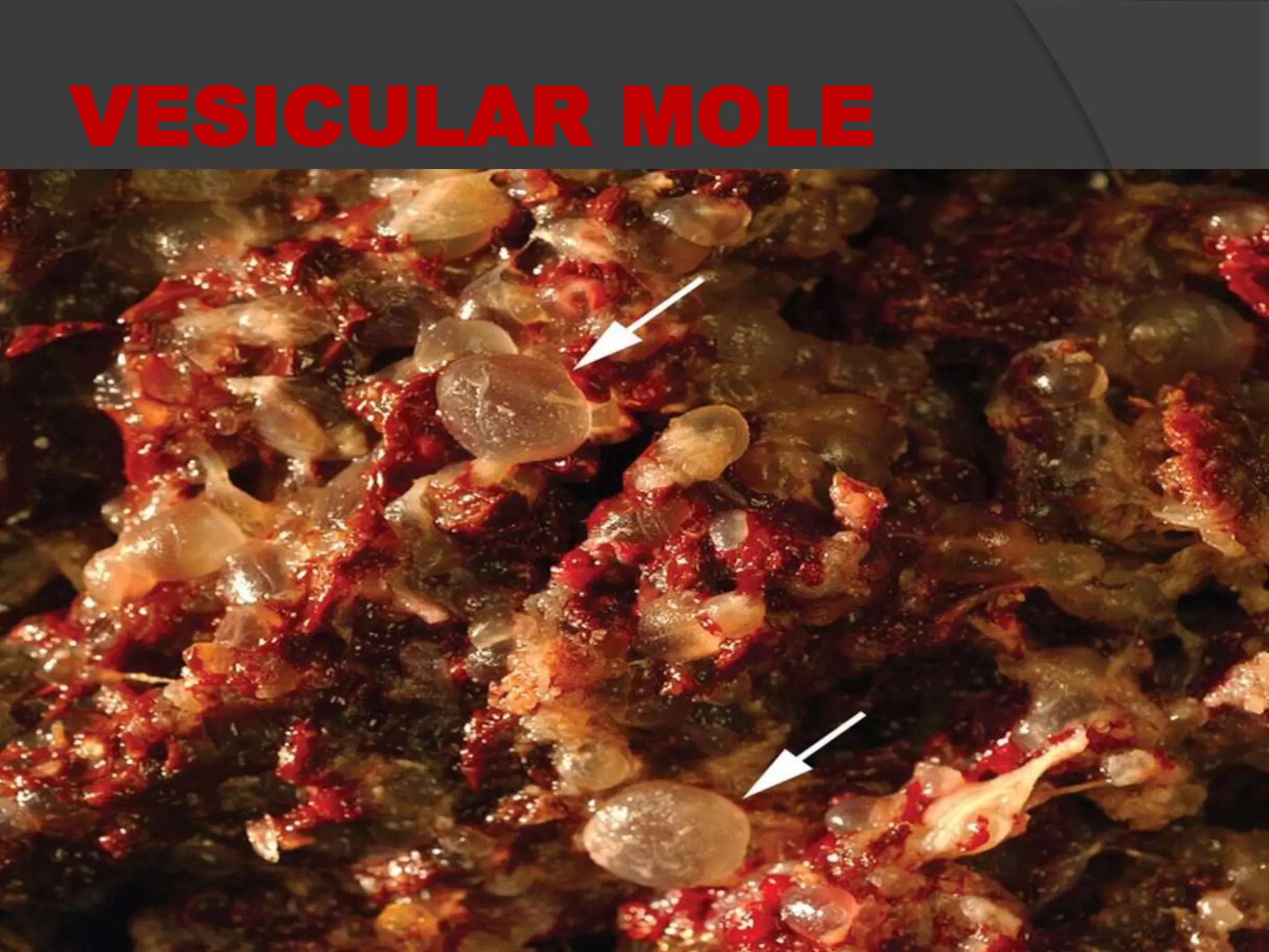 GINCY -VESICULAR MOLE in pregnancy in obstetric and gynecology | PPTX