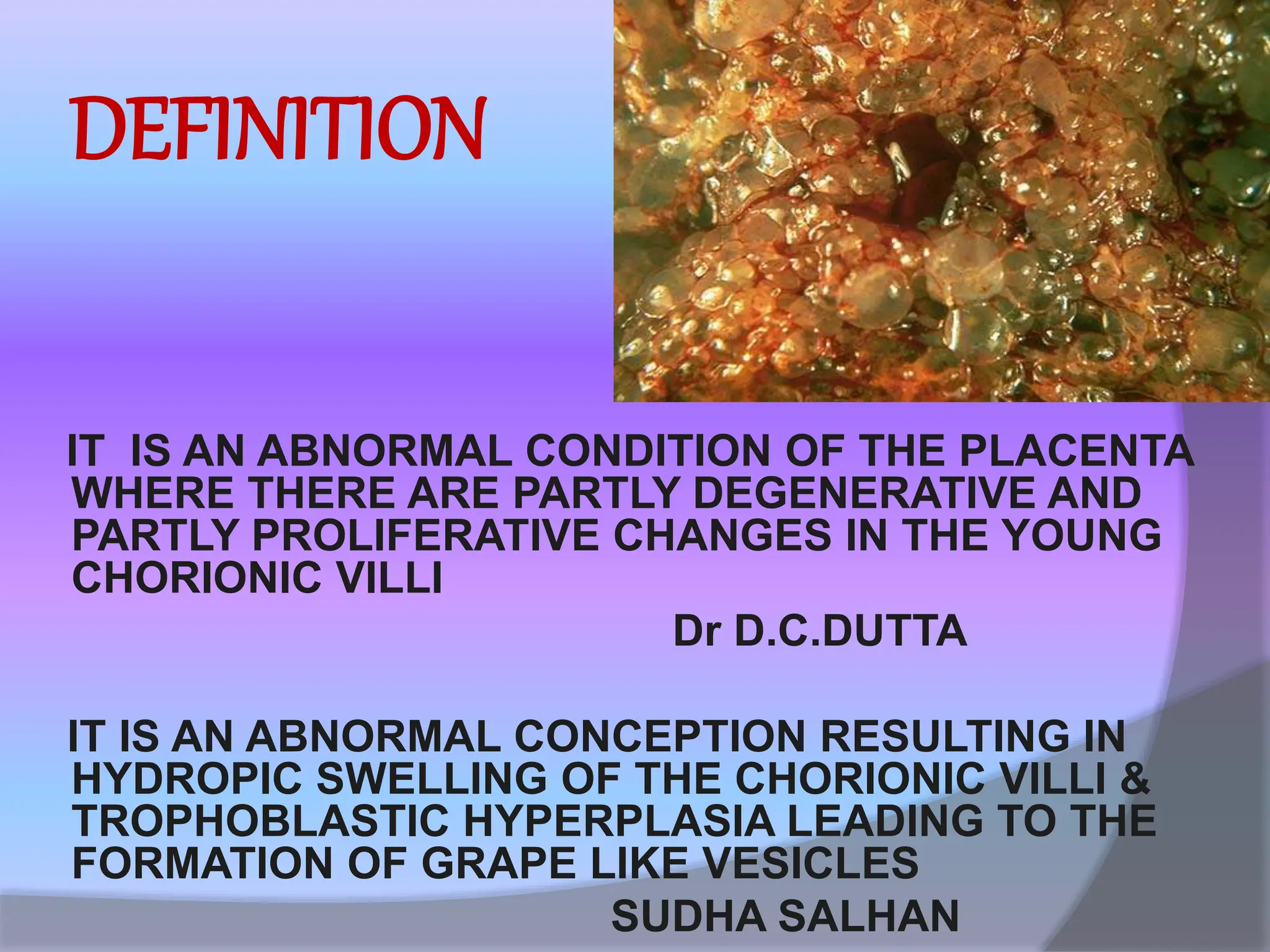 GINCY -VESICULAR MOLE in pregnancy in obstetric and gynecology | PPTX