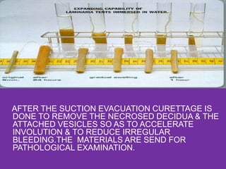 GINCY -VESICULAR MOLE in pregnancy in obstetric and gynecology | PPTX