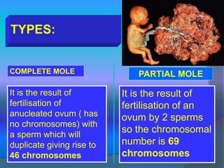 GINCY -VESICULAR MOLE in pregnancy in obstetric and gynecology | PPT