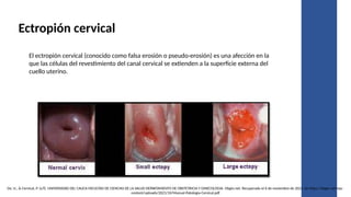 ginecologia patologia benignos del cervix | PPTX