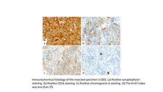 GI NETs- a type of ppt of gastroenterology neuroendocrine tumors | PPTX