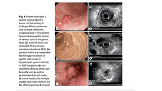 GI NETs- a type of ppt of gastroenterology neuroendocrine tumors | PPTX