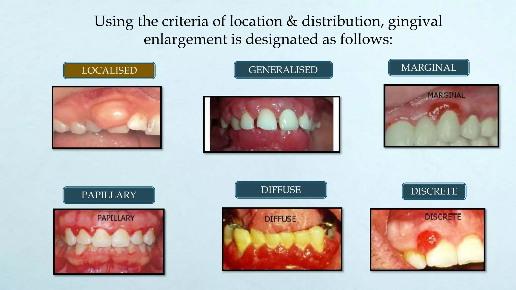 Gingival enlargement | PPTX