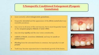 Gingival enlargement | PPTX