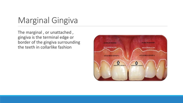 Gingiva | PPTX