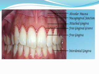 Gingiva | PPT
