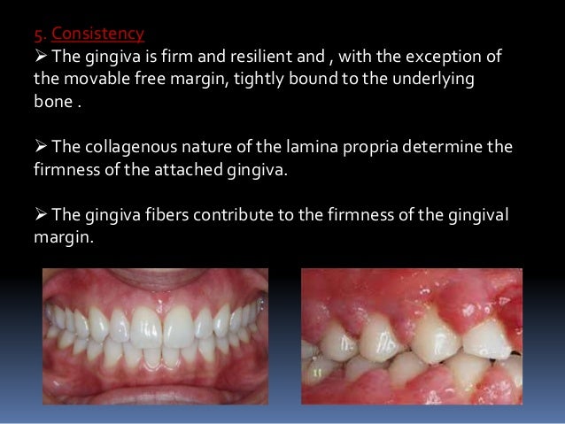 Gingiva