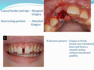 Gingiva. | PPTX