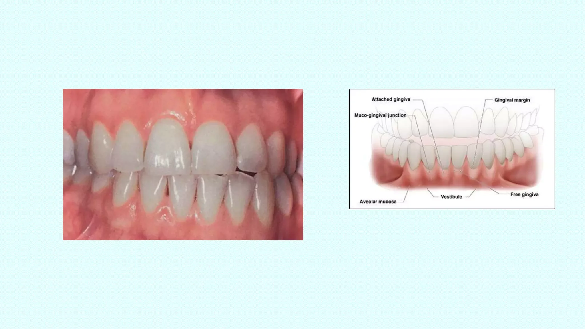 Gingiva | PPT
