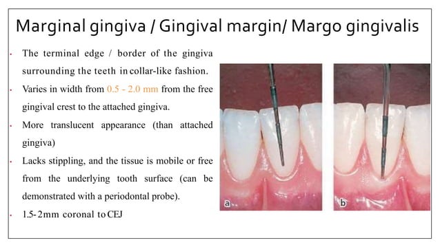 Gingiva Periodontology | PPTX | Dental Health | Diseases and Conditions