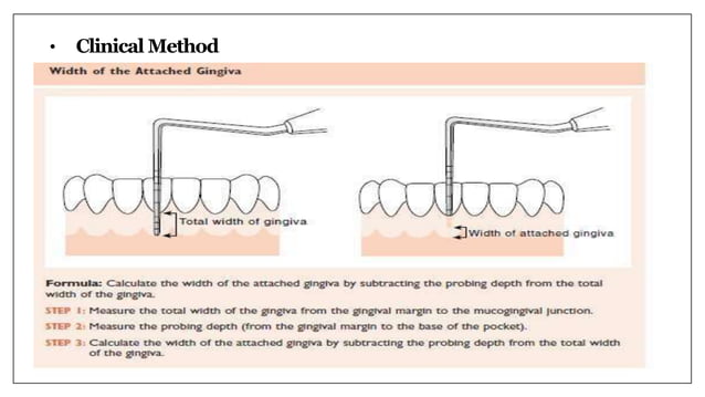 Gingiva Periodontology | PPTX | Dental Health | Diseases and Conditions