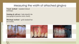 STRUCTURE AND FUNCTION OF GINGIVA IN PERIODONTICS | PPTX