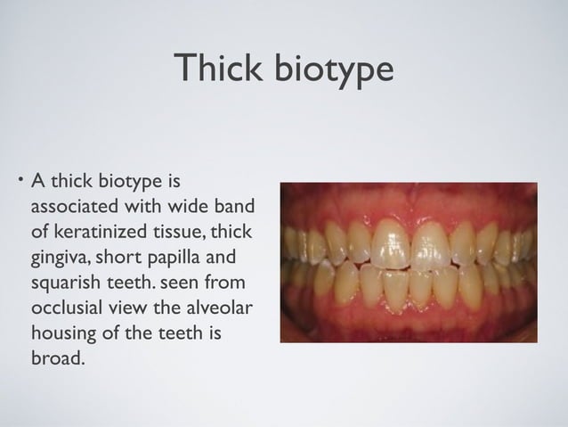 Gingiva biotype | PPT