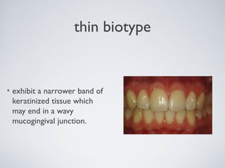 Gingiva biotype | PPT