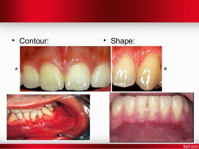 Gingiva in health and disease