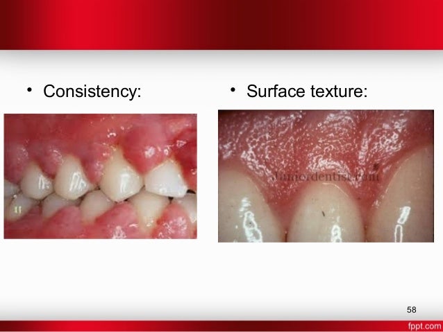 Gingiva in health and disease
