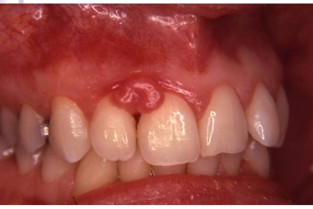 Gingivaland papillary.comp