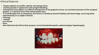Gingival and Periodontal diseases in children pediatric dentistry .pptx