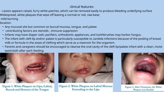 Gingival and Periodontal diseases in children pediatric dentistry .pptx