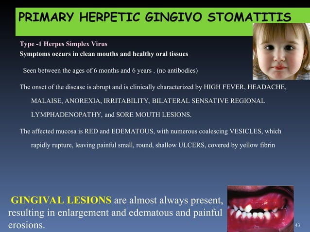 GINGIVAL AND PERIODONTAL DISEASES IN CHILDREN - Dr K. Harish.ppt | Oral care | Personal Care