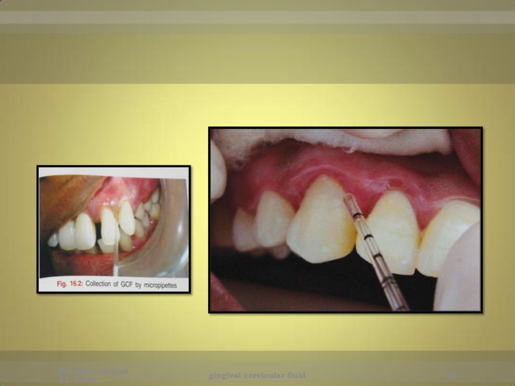 Gingival crevicular fluid