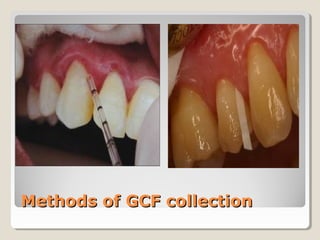 Defence Mechanism of Gingivae | PPT