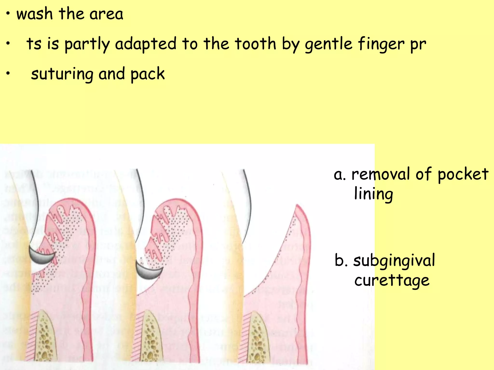 Gingival curettage | PPT