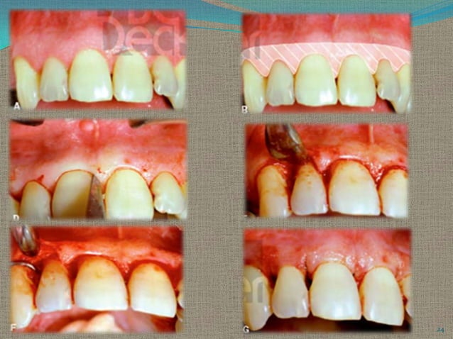 Gingival curettage | PPTX | Dental Health | Diseases and Conditions