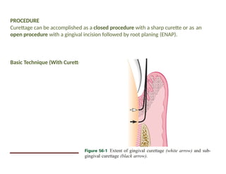 Gingival Curettage in periodontal pockets | PPTX
