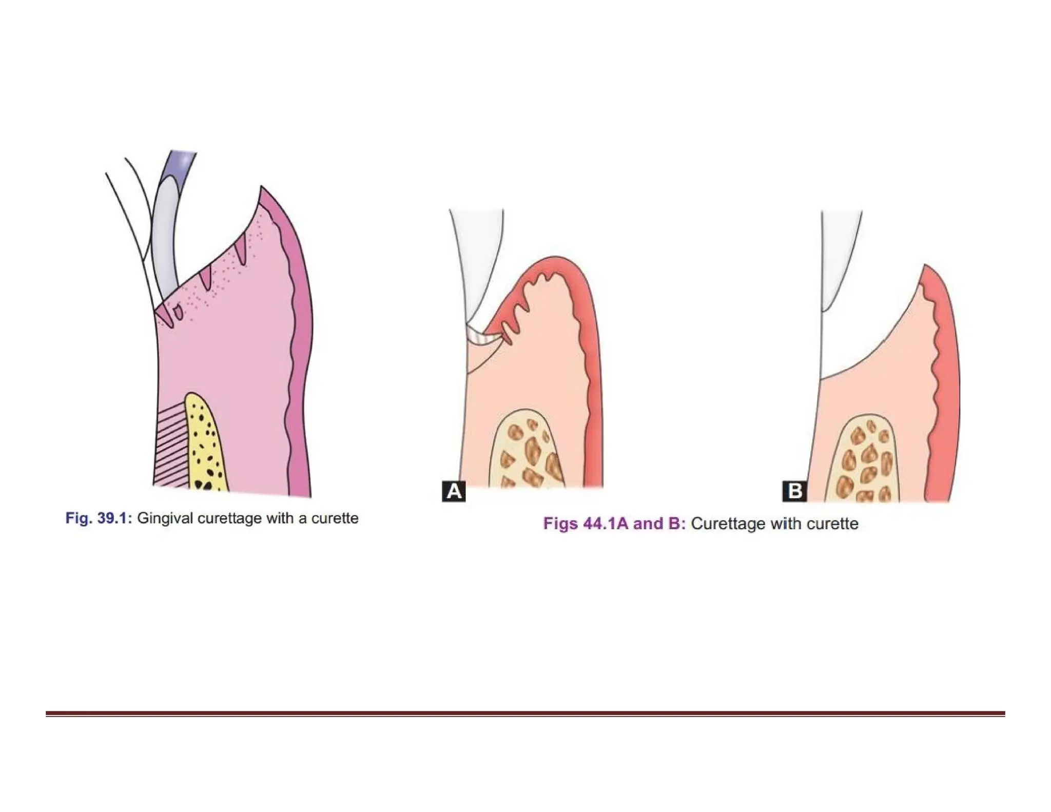 Gingival Curettage in periodontal pockets | PPTX