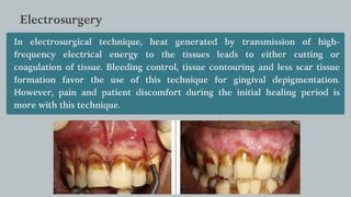 Gingival Depigmentation ............pptx
