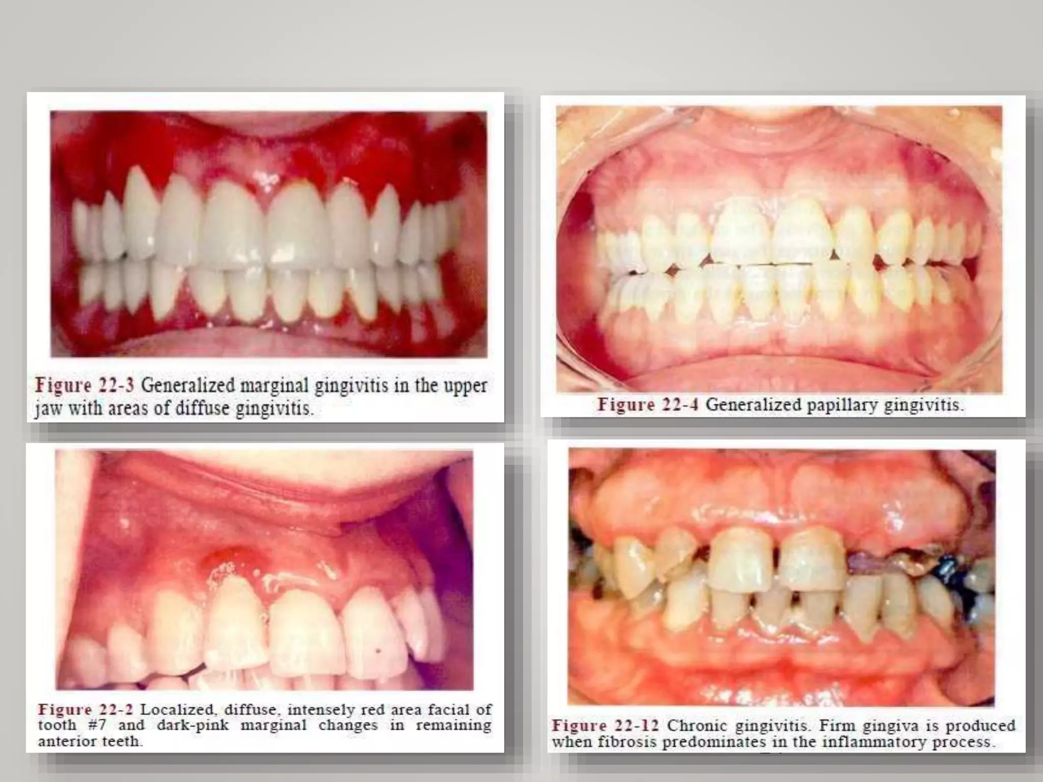 gingival disease...pptx