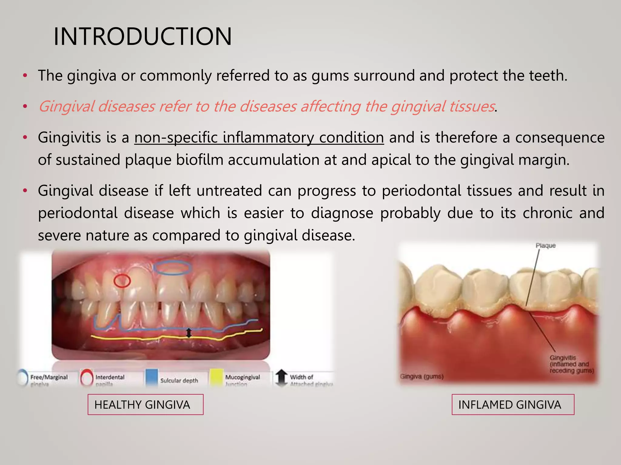 gingival disease...pptx