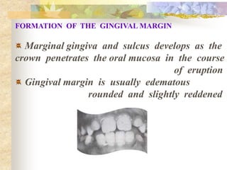 GINGIVAL DISEASE IN CHILDHOOD.ppt