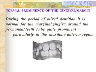 GINGIVAL DISEASE IN CHILDHOOD.ppt