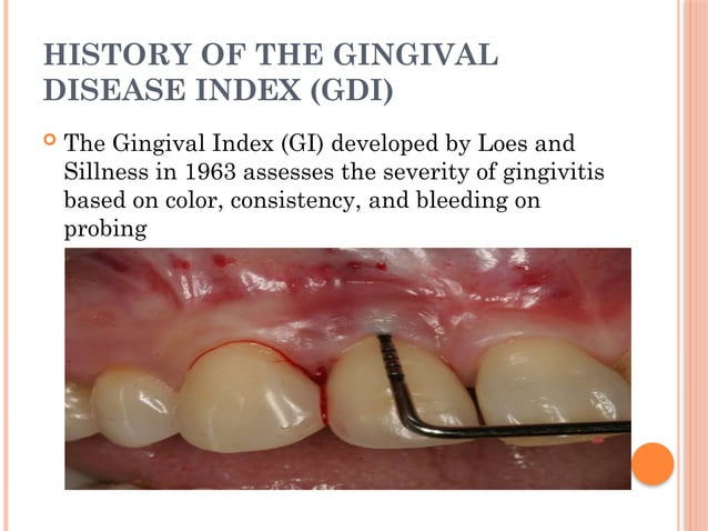 Gingival Disease Index (GDI).pptx for dentistry students | PPT