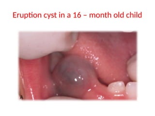 Gingival diseases in childhood.pptx sneha | PPTX