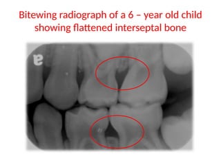 Gingival diseases in childhood.pptx sneha | PPTX