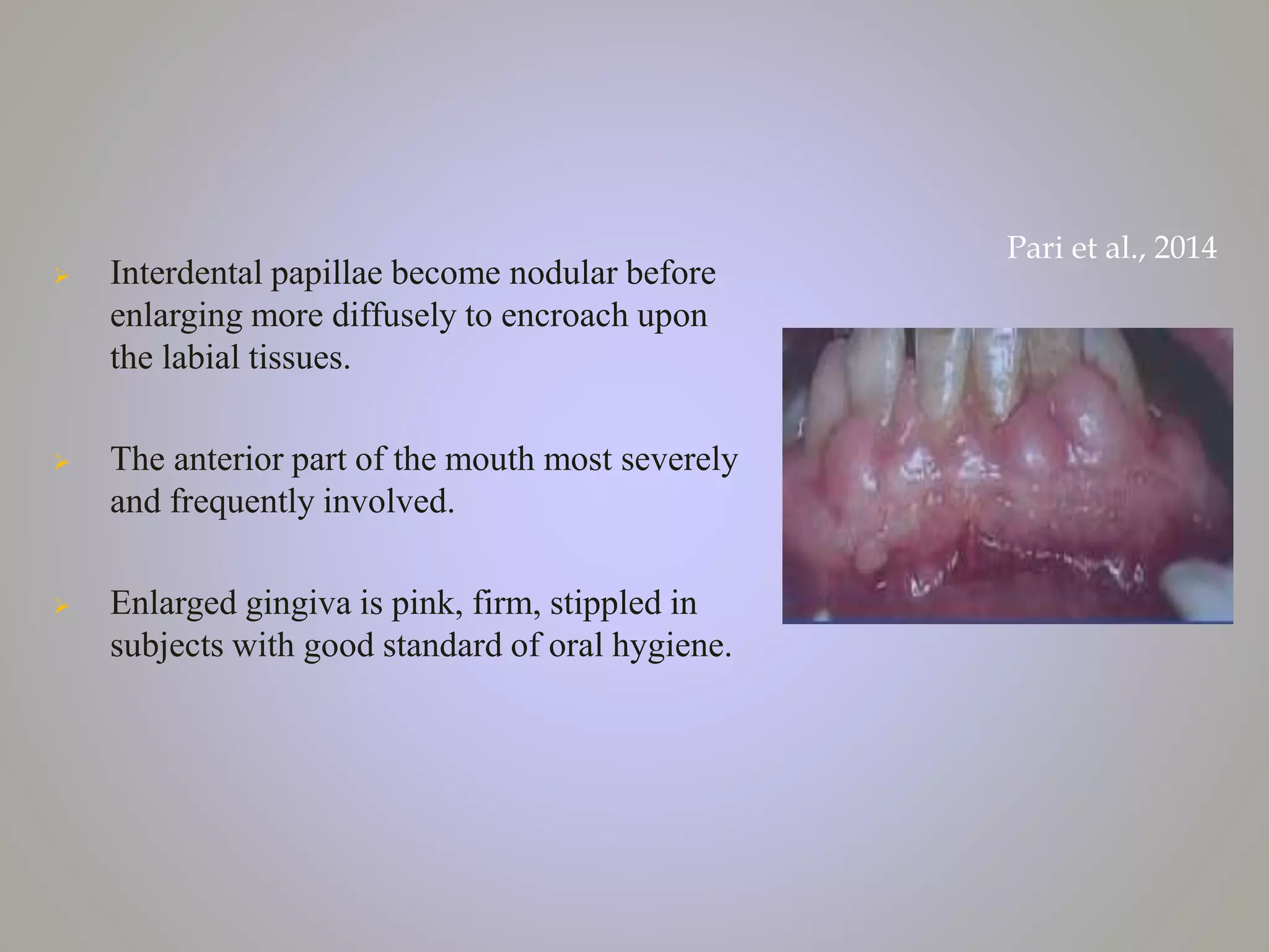 Gingival diseases in children | PPTX