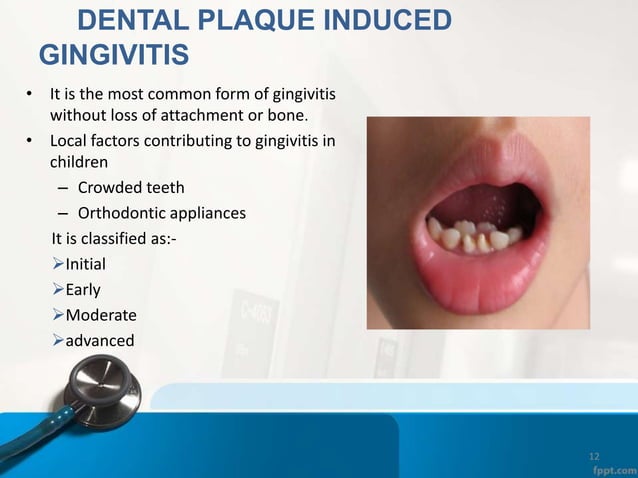 Gingival diseases in children | PPTX | Oral care | Personal Care