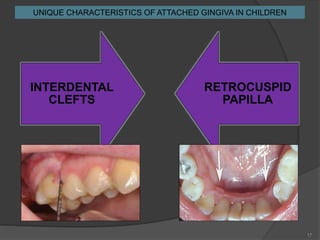 Gingival diseases in childhood | PPT